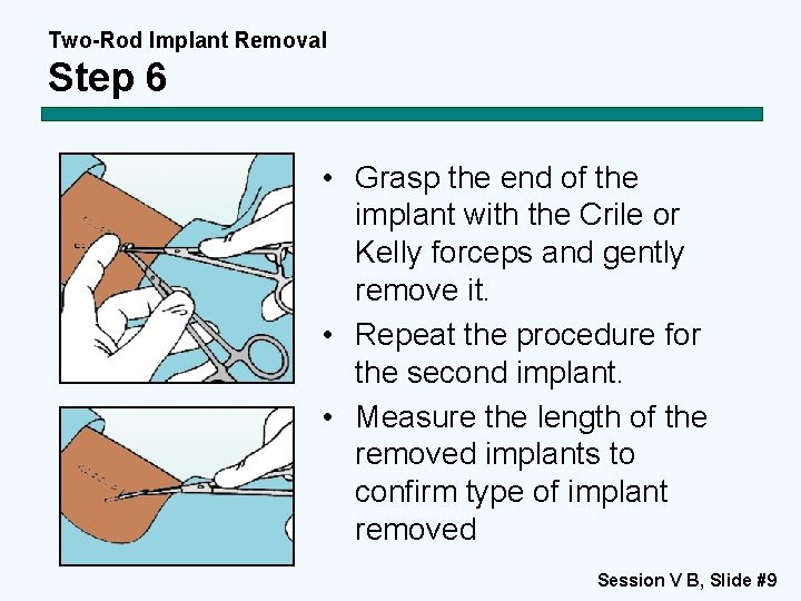 Contraceptive Implants Session V B TwoRod Implant Removal