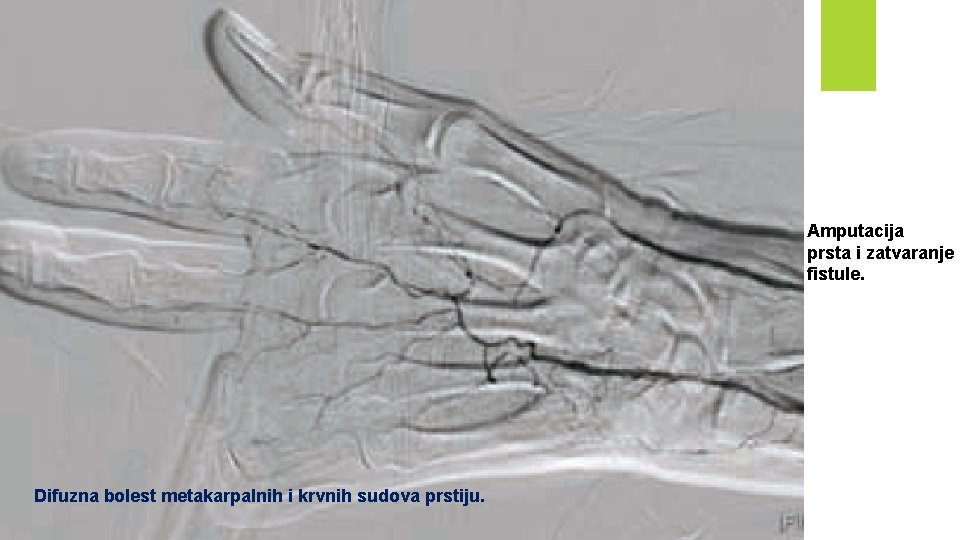 Dijaliza u bolesnika s dijabetinom nefropatijom ENISA MEI