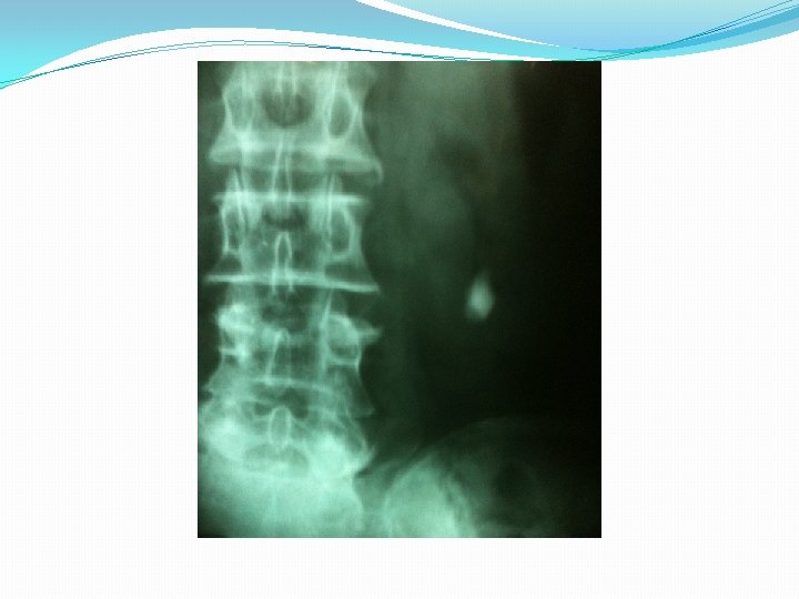 Extracorporeal Shockwave lithotripsy ESWL Epidemiology Nephrolithiasis ...