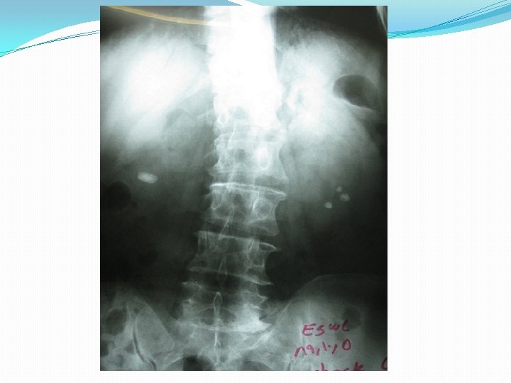 Extracorporeal Shockwave lithotripsy ESWL Epidemiology Nephrolithiasis ...
