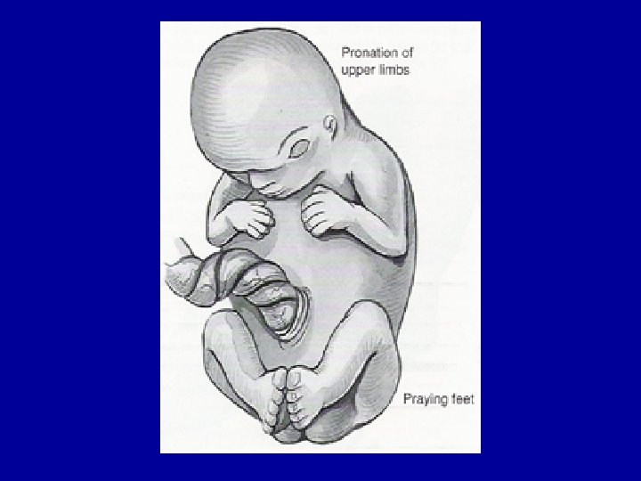Rotational Deformity of Lower Extremity in Children Embryology