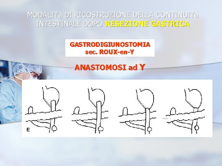 PATOLOGIA del GASTRORESECAT O RESEZIONE GASTRICA BILLROTH II