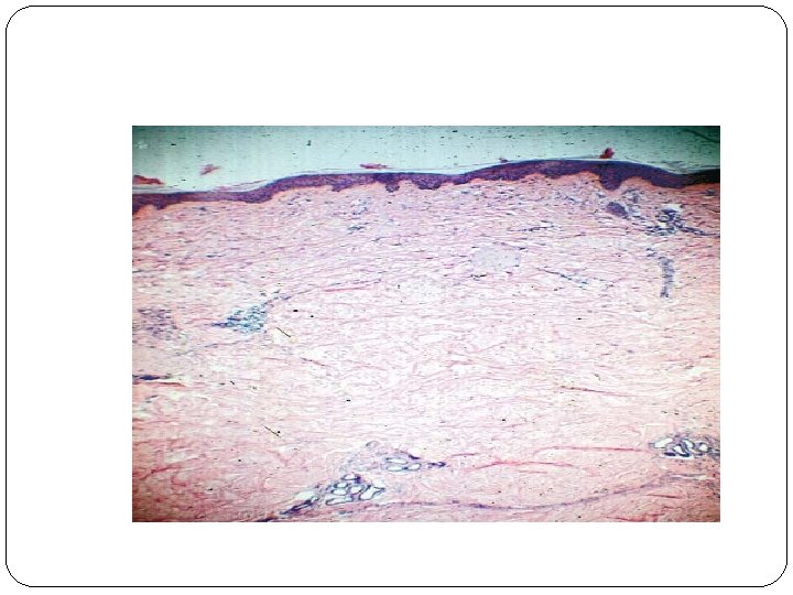 Scleroderma Morphea Dr Rzan Objectives 1 define Identify