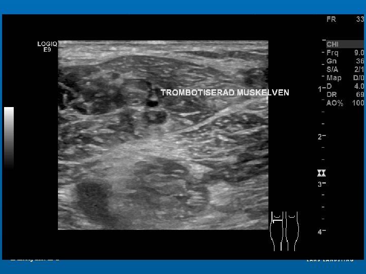 DVTdiagnostik Fraktur Muskelruptur Hjrtsvikt Rupturerad Bakercysta ...