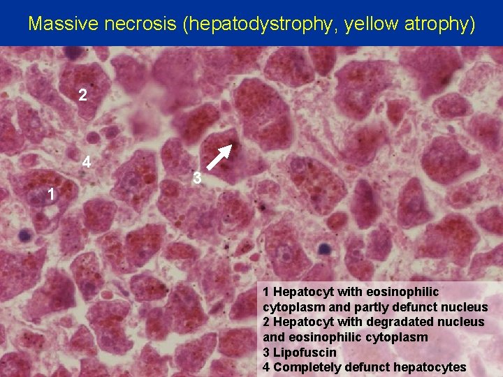 PATHOLOGY OF THE LIVER VII practical training 3