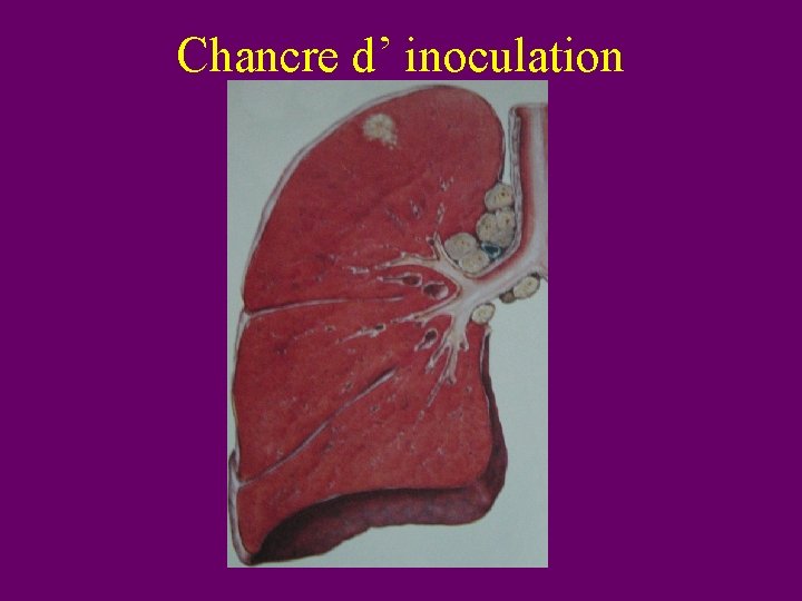 Tuberculose dans le monde Region Population infecte 106