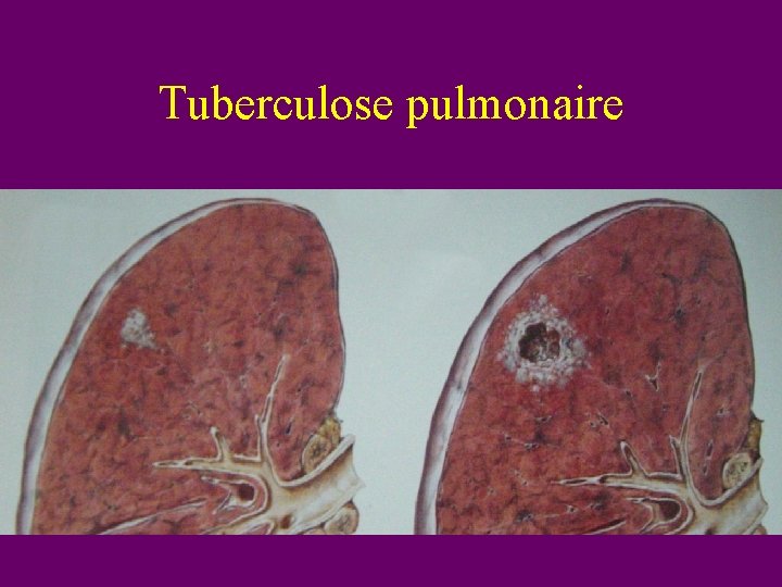 Tuberculose dans le monde Region Population infecte 106