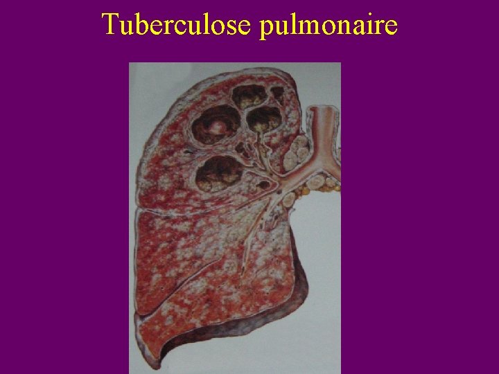 Tuberculose dans le monde Region Population infecte 106