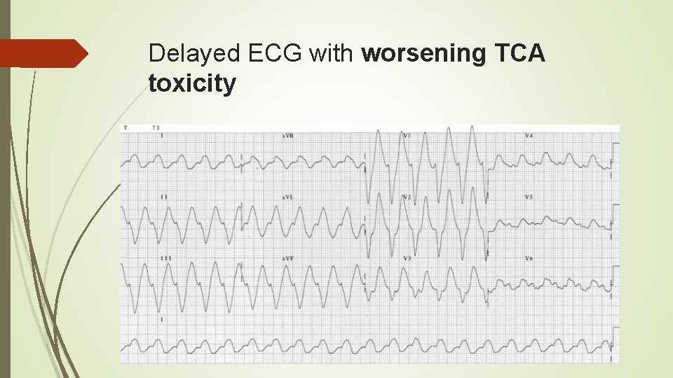 ECG Manifestations The Poisoned Patient Ehsan Bolvardi M