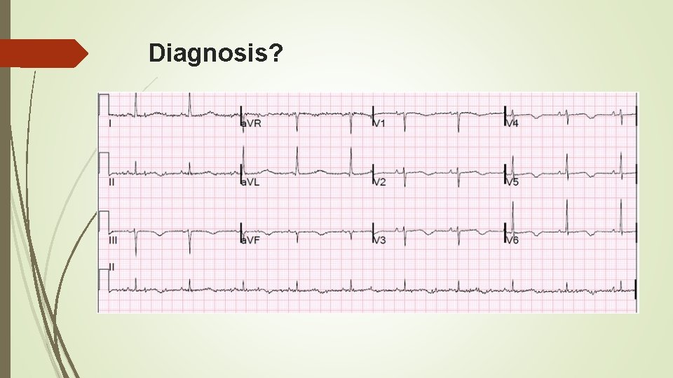 ECG Manifestations The Poisoned Patient Ehsan Bolvardi M