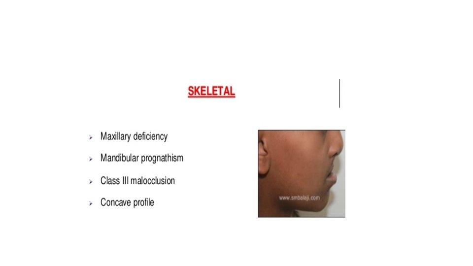 Cleft lip cleft palate and craniofacial syndromes Dr