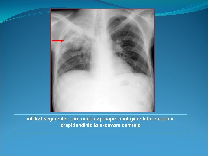 Clinica tuberculozei Grigoriu Bogdan Ianuarie 2009 Tuberculoza ...