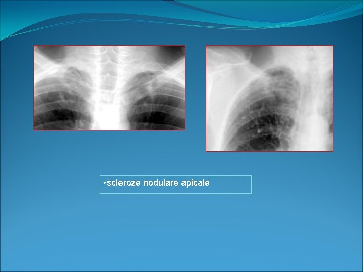Clinica tuberculozei Grigoriu Bogdan Ianuarie 2009 Tuberculoza ...