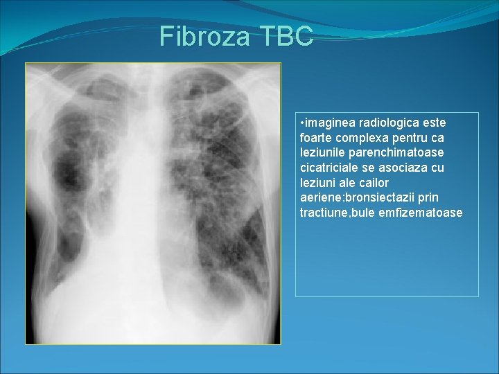 Clinica tuberculozei Grigoriu Bogdan Ianuarie 2009 Tuberculoza ...
