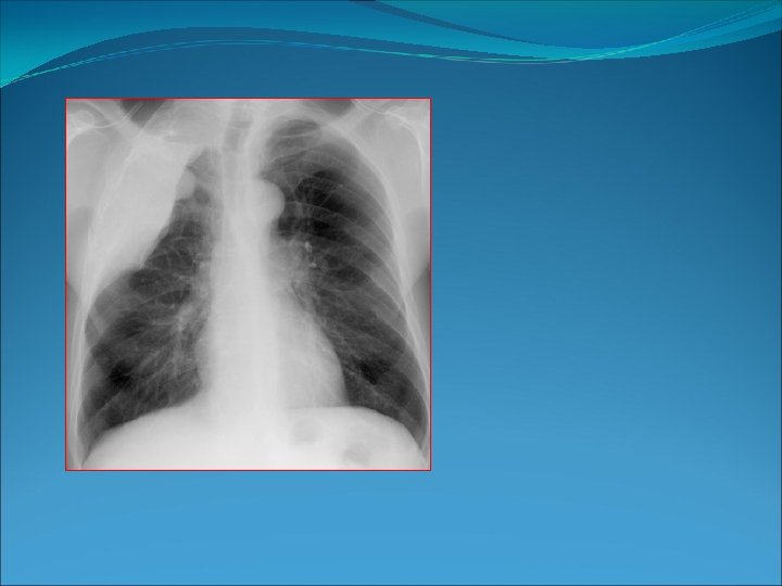 Clinica tuberculozei Grigoriu Bogdan Ianuarie 2009 Tuberculoza ...