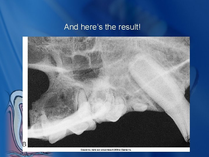 Intraoral Radiographs Introduction In order to see what