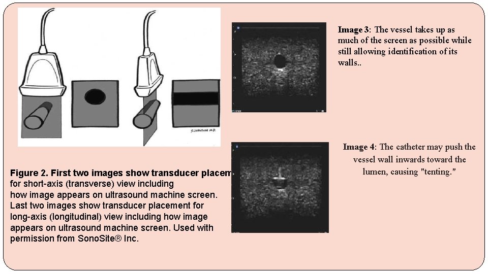 Ultrasound Guided Peripheral IV Insertion in the Emergency