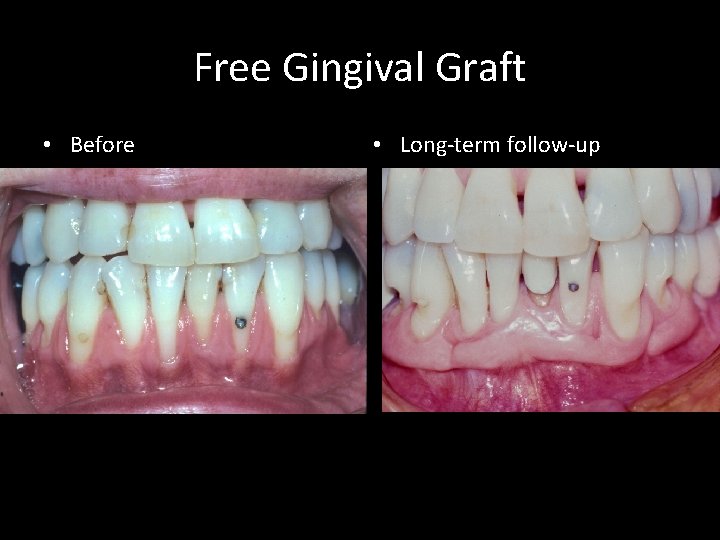 Periodontal Plastic Surgery Soft Tissue Grafting Indications and