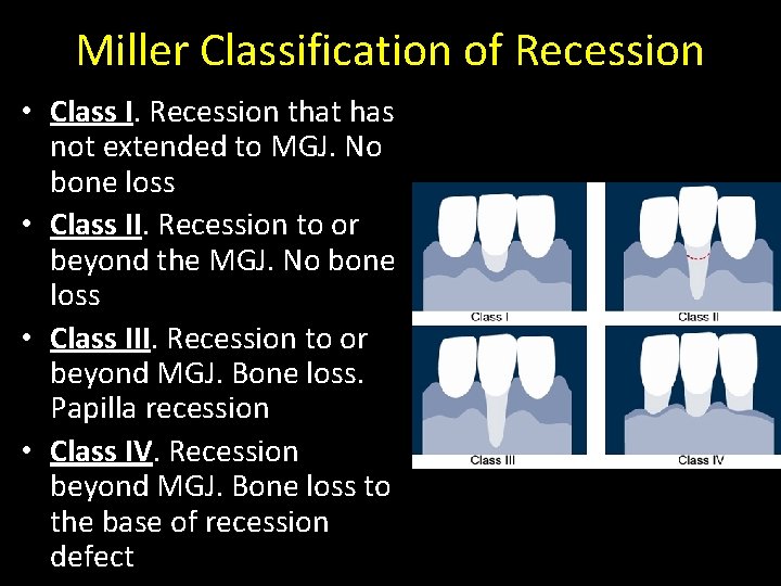 Periodontal Plastic Surgery Soft Tissue Grafting Indications and