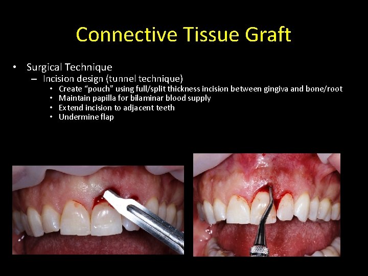 Periodontal Plastic Surgery Soft Tissue Grafting Indications and