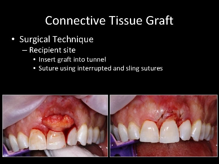 Periodontal Plastic Surgery Soft Tissue Grafting Indications and