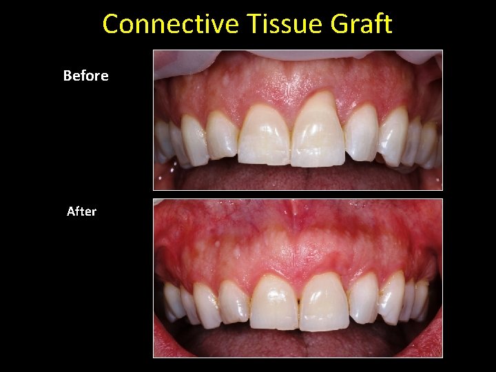 Periodontal Plastic Surgery Soft Tissue Grafting Indications and