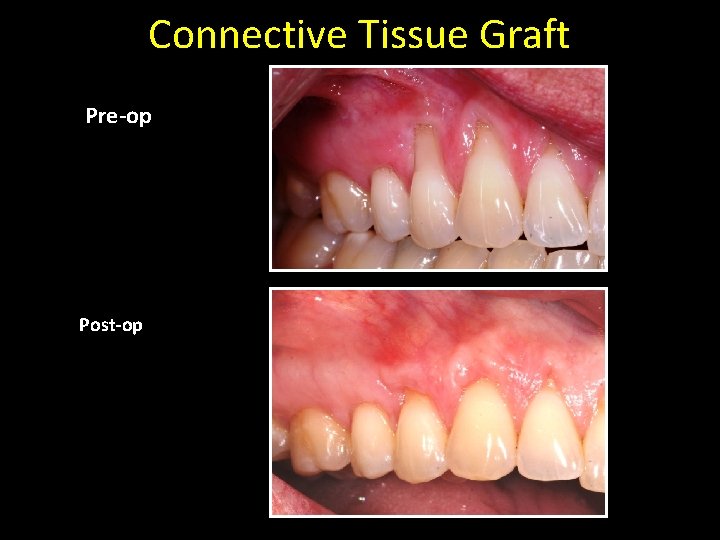 Periodontal Plastic Surgery Soft Tissue Grafting Indications and