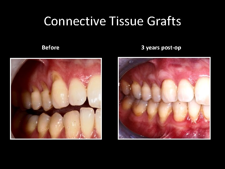 Periodontal Plastic Surgery Soft Tissue Grafting Indications and