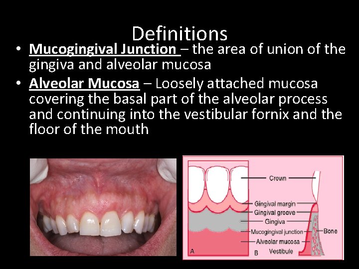 Periodontal Plastic Surgery Soft Tissue Grafting Indications and