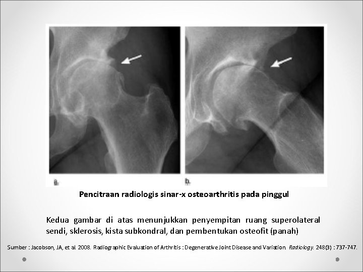 Osteoarthritis OA Sylvia Rachman 1 1 Latar Belakang