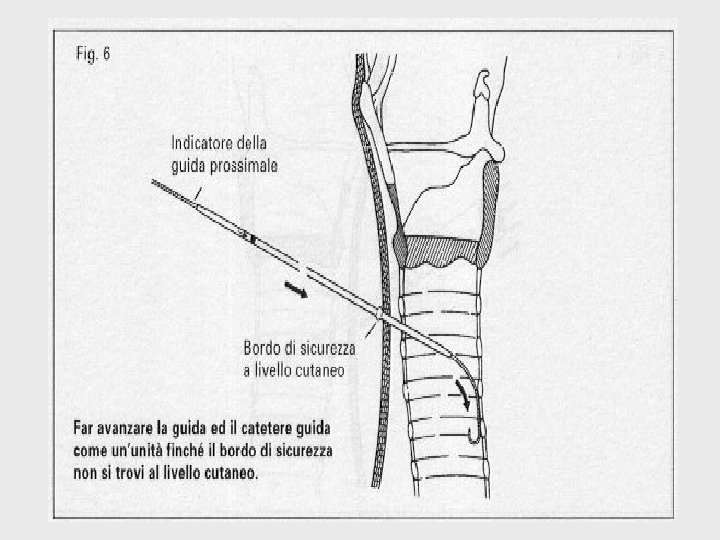 LA TRACHEOTOMIA PERCUTANEA SCELTA DI TECNICA O SCELTA