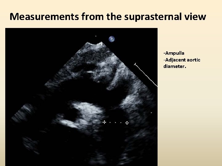 Echocardiographic assessment of Patent Ductus Arteriosus Dr Sandeep