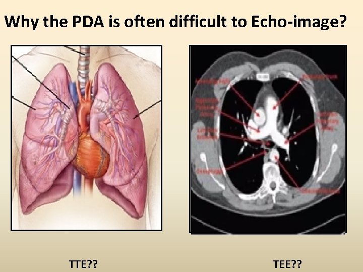 Echocardiographic assessment of Patent Ductus Arteriosus Dr Sandeep