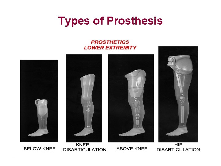 Lower Limb Prostheses Description There are several levels