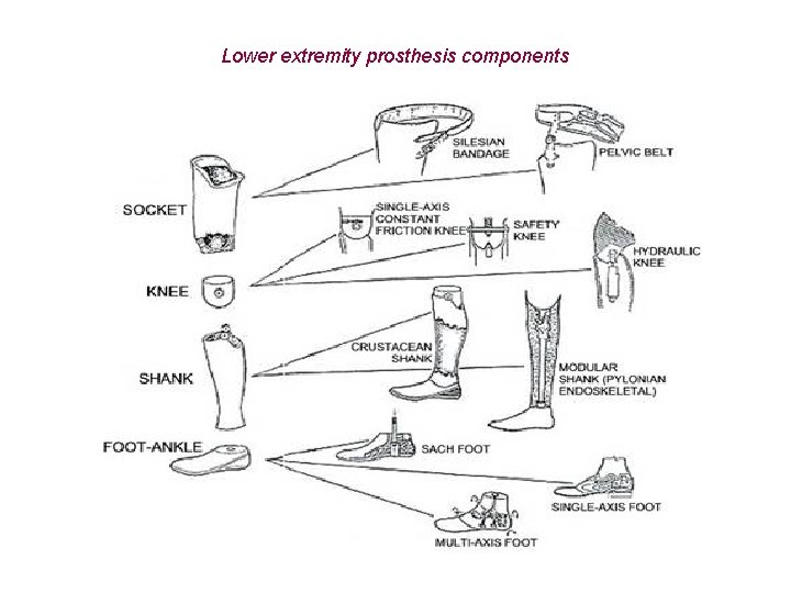 Lower Limb Prostheses Description There are several levels