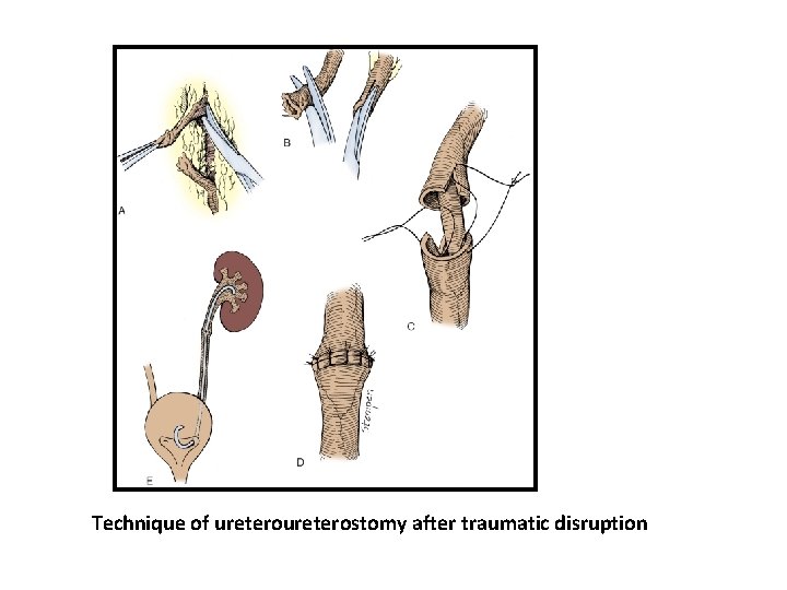Kidney and Ureters Trauma Dr Amit Gupta Associate