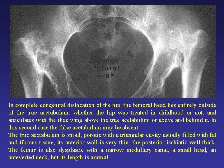 THR ON DDH CROWE IV Technique and long