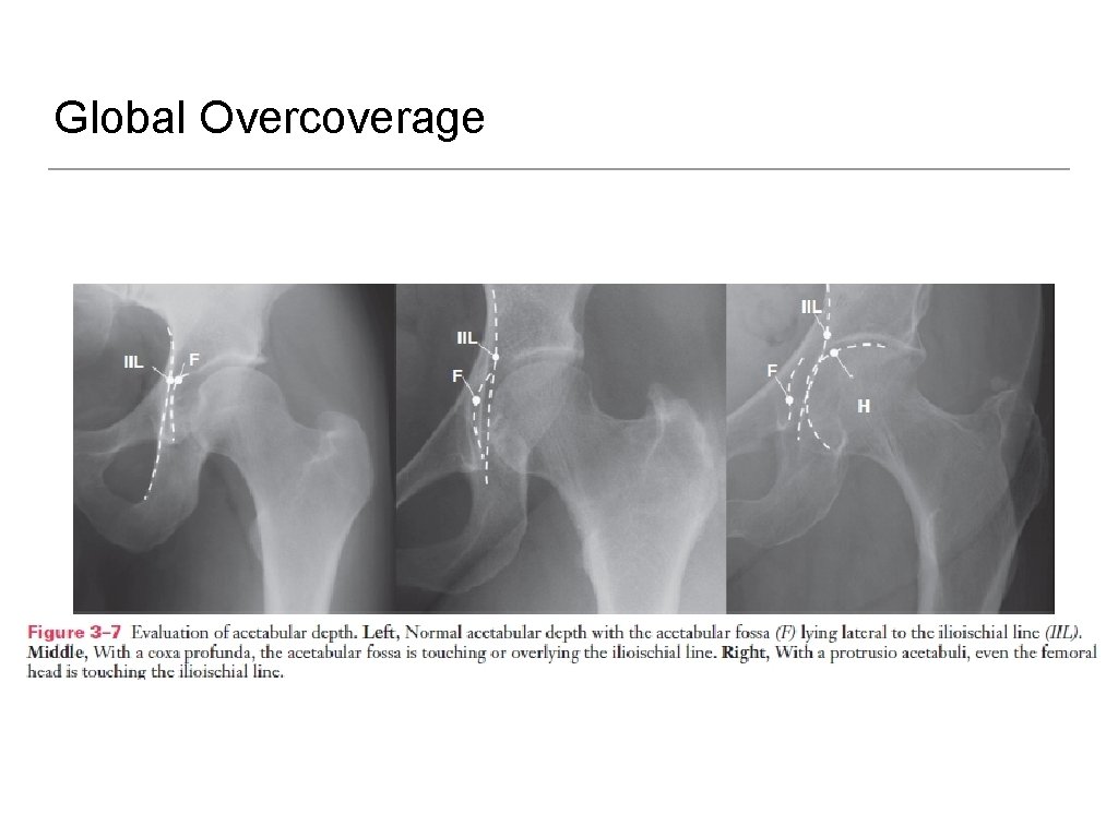 Femoroacetabular Impingement and Hip Arthroscopy Ian Rice M