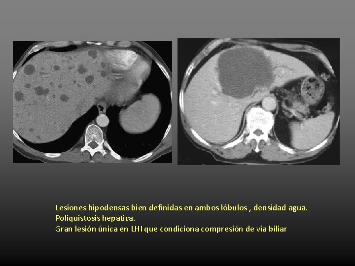 Quiste heptico simple Quiste heptico simple Congnito 2