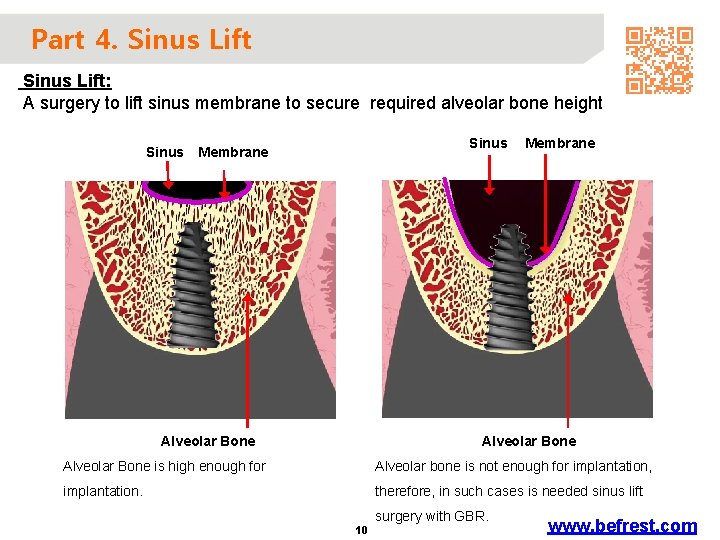 v Basic Course Understanding of sinus surgery Slides