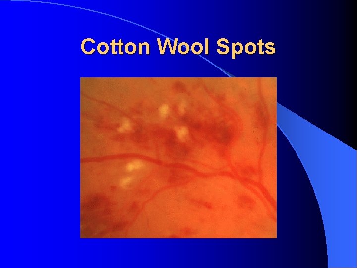 Diabetic Retinopathy Epidemiology l l l The World