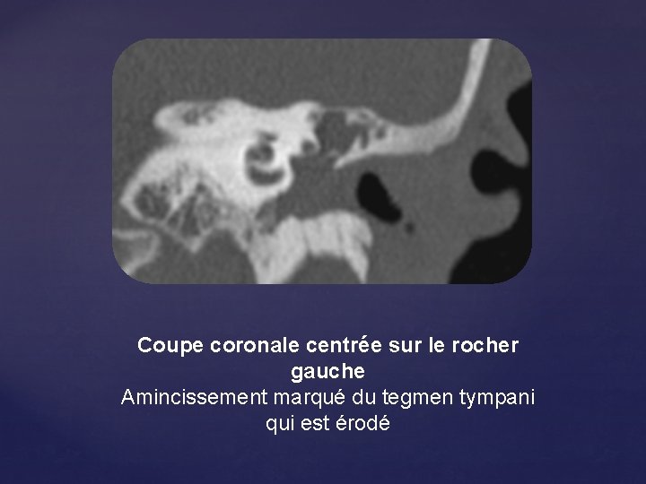 OTITE CHOLESTEATOMATEUSE APPORT DE LA TDM HAUTE RESOLUTION