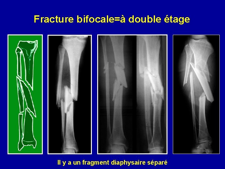 Gnralits sur les fractures des membres DEFINITION CLASSIFICATION