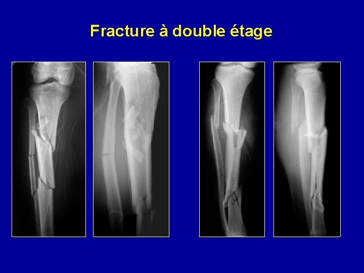 Gnralits sur les fractures des membres DEFINITION CLASSIFICATION
