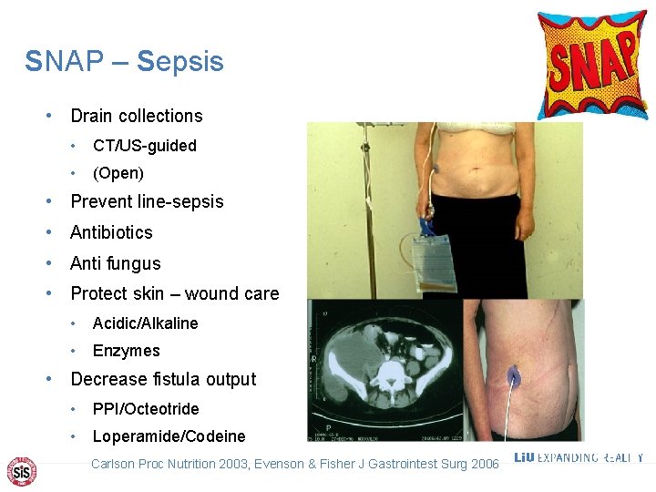 SNAP How to treat enterocutaneous fistulas Oslo March