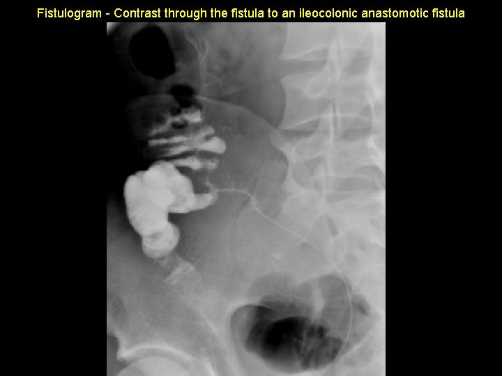 SNAP How to treat enterocutaneous fistulas Oslo March