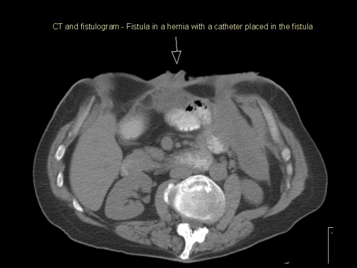 SNAP How to treat enterocutaneous fistulas Oslo March