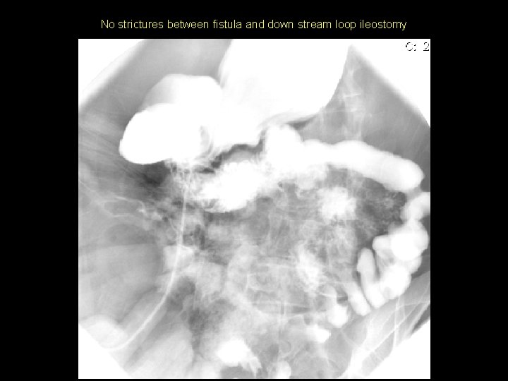 SNAP How to treat enterocutaneous fistulas Oslo March