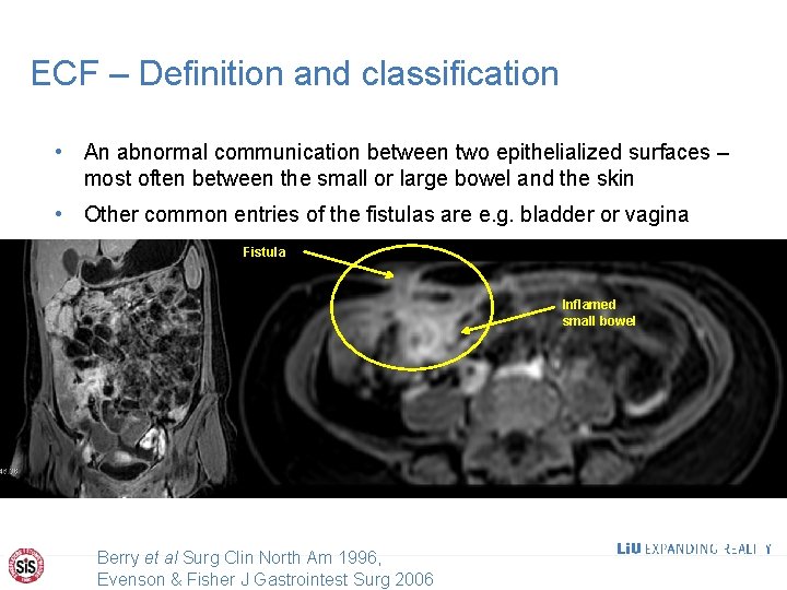 SNAP How to treat enterocutaneous fistulas Oslo March