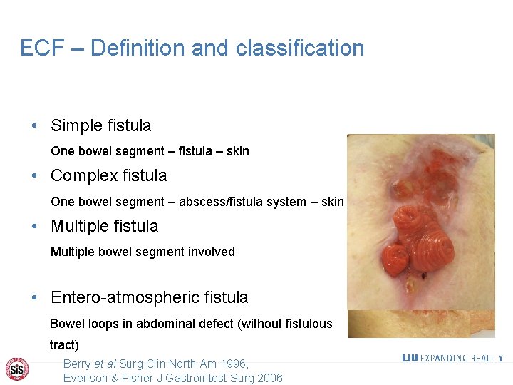 SNAP How to treat enterocutaneous fistulas Oslo March